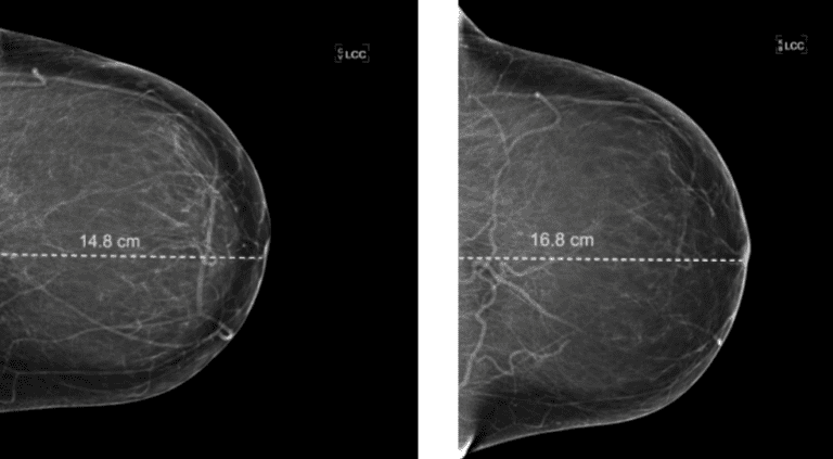Repeats, Rejects and Recalls: How Many is Too Many? – Mammography Educators